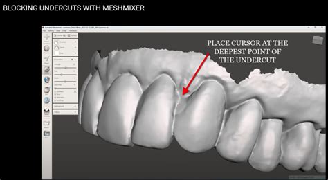 Blocking Undercuts With Meshmixer Adaptive Orthodontics