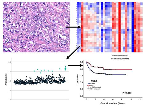 Ai Uncovers New Prognostic Markers In Diffuse Large B Cell Lymphoma Aspire Precision Medicine