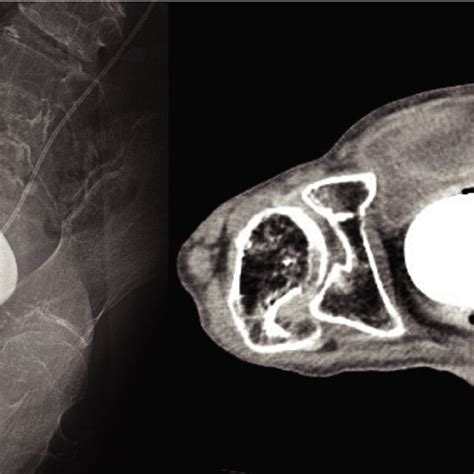 Abdominal Ct Shows A Calculus In The Pelvis Measuring Download