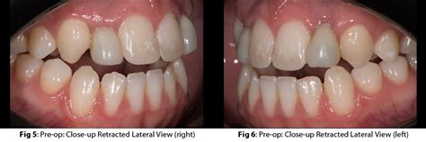 Before And After 2019 Missing Tooth Replacement On Lateral Incisors