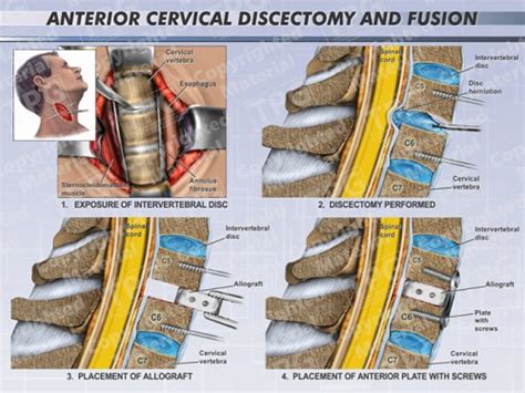 Anterior Cervical Discectomy And Fusion Female 2 Order