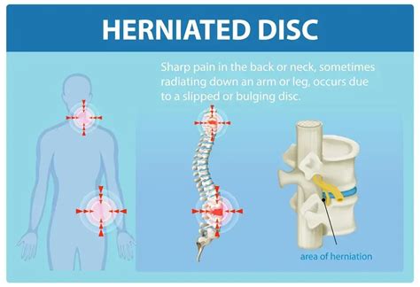 How Long Does A Herniated Disc Take To Heal Know Here Credihealth