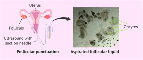 What Are The Single Steps Of Egg Donation