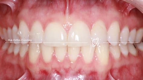 Evaluating Invisalign Tracking And Attachment Flash The Ortho Cosmos