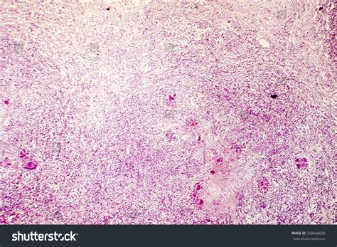 Liquefaction Necrosis Brain