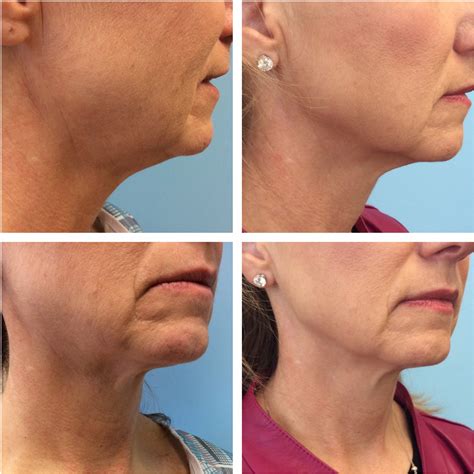 Ultherapy Non Surgical Lift Lake Forest Dermatology Bannockburn