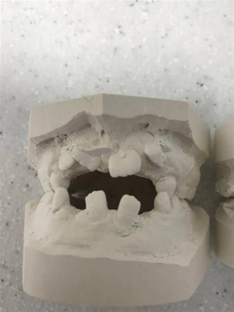 18 Years Finally Done R Braces