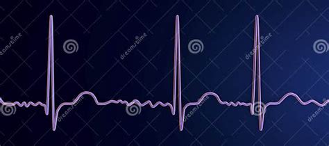 Ecg In Atrial Fibrillation 3d Illustration Stock Illustration Illustration Of Afib