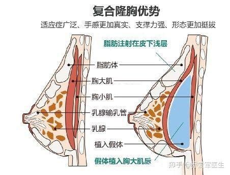 胸部松弛下垂可以做自体脂肪隆胸吗京韩乔爱军院长脂肪丰胸科普 知乎