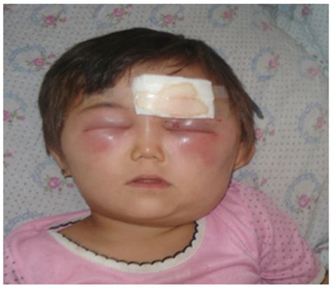 Human Anthrax Update Of The Diagnosis And Treatment