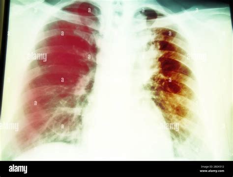 Chest X Ray Examination For Diagnosis Lung Infection With Right Lung
