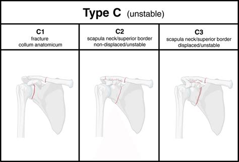 Scapula Fracture Classification At Reynaldo Leahy Blog
