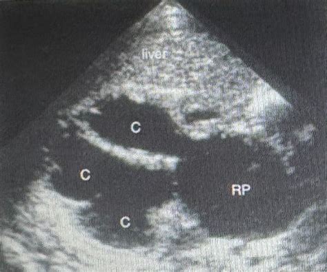 Neonatal Renal Flashcards Quizlet