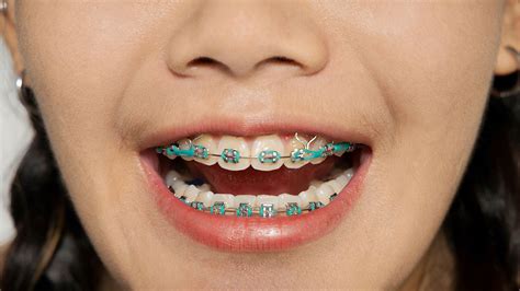 Braces With Rubber Bands Purpose And How Long They Stay On Braces Rubber Bands Braces