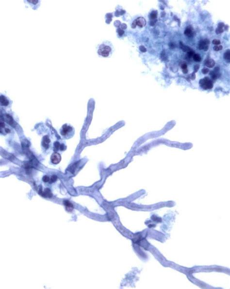 Кандидозный баланопостит симптомы лечение в Москве