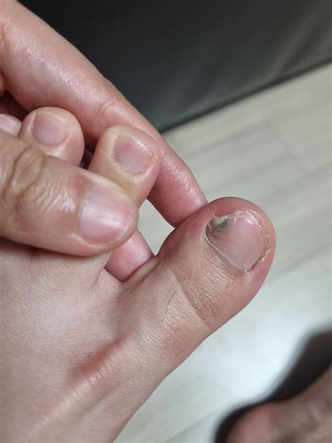 엄지발가락 멍 아님 점 지식in