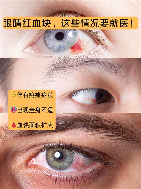 眼睛红血块，这些情况要就医！