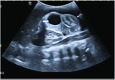 Pathological Intussusception Secondary To Meckels Diverticulum In A 2 Download Scientific