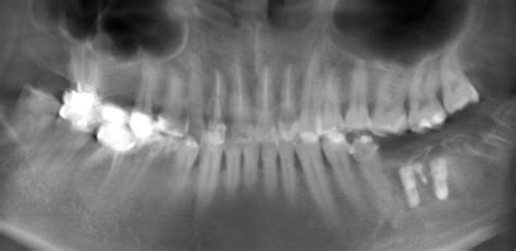 St Internal Hex Connection Implant System T Plus Dental Implants