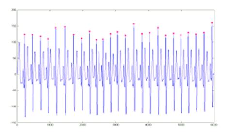 QRS Detection Recording 212 Mat Download Scientific Diagram