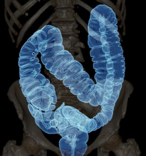 Ct Colonography Or Ct Scan Of Colon 3d Rendering Image Ap View Showing