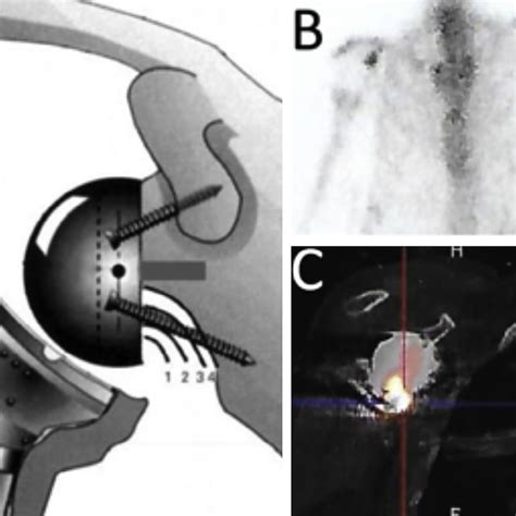 A Classification For The Humeral Component Image Courtesy Of Prof