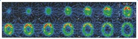 Tmj Bone Scintigraphy Indicates More Uptake Of The Radiopharmaceutical