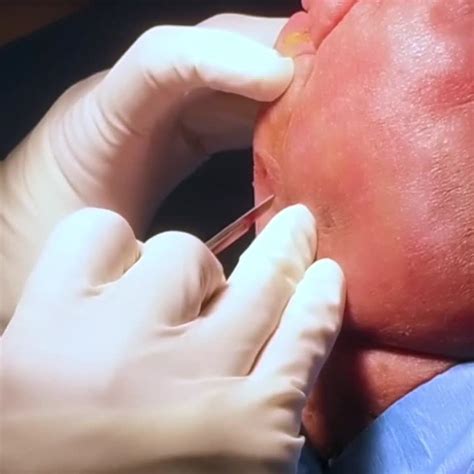 Haywan Chiu Dpm Facfas On Linkedin Floating Metatarsal Osteotomy Is