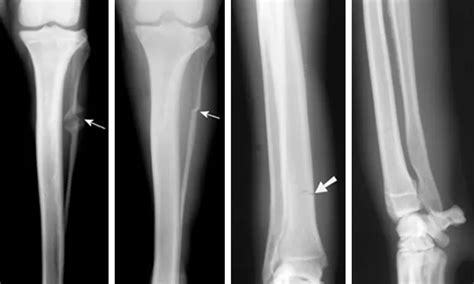 Hairline Bone Fracture
