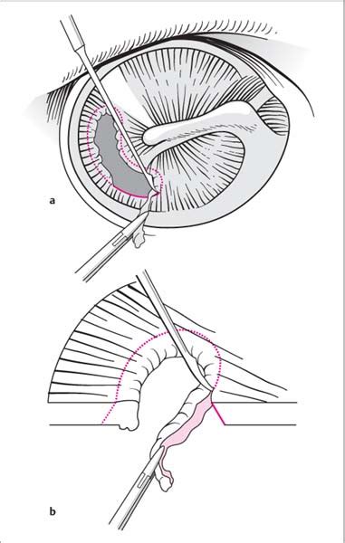 Tympanoplasty Ento Key