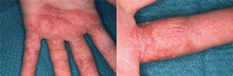 Chronic Allergic Contact Dermatitis Related To Playstation Controller