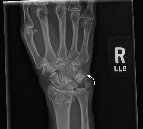 Associated Ulnar Fixation Ulnar Styloid And Metadiaphyseal Fractures