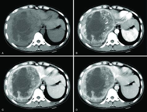 A Nonenhanced Computed Tomography Ct Scan Showing A Large Download Scientific Diagram