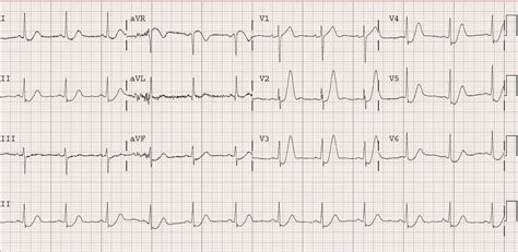 Hyperacute T Waves Dr Smiths Ecg Blog