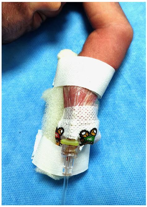 Peripheral Intravenous Cannulae In Neonates To Splint Or 44 Off