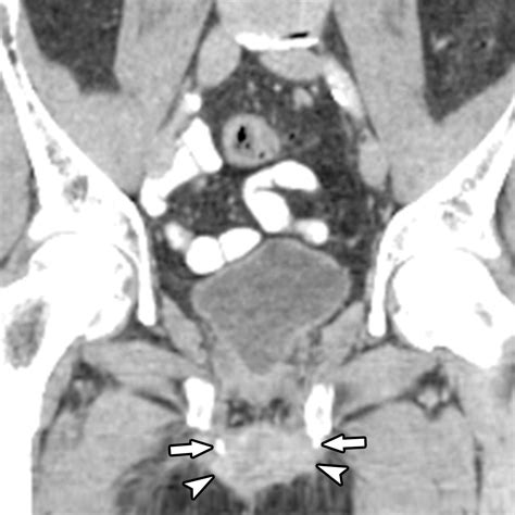 Imaging And Treatment Of Complications Of Abdominal And Pelvic Mesh