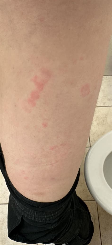 Had Scabies For 6months With No Luck Rscabies