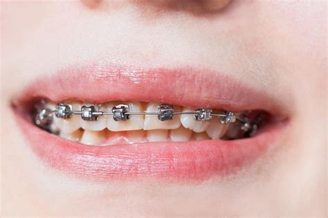 Premium Photo Front View Of Dental Braces On Teeth Of Upper Jaw