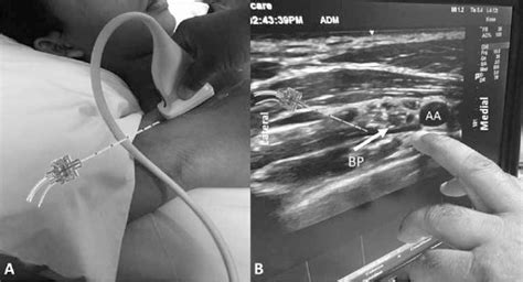 Infraclavicular Block