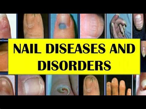 Nail Diseases And Disorders Nail Diseases Pictures Photos