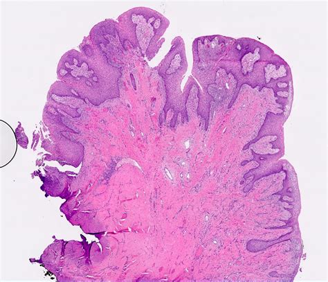 Inflammatory Papillary Hyperplasia Histology