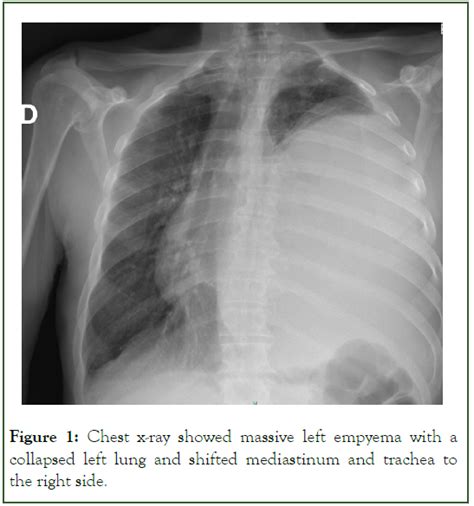 synchronous differential independent lung ventilation scenario a