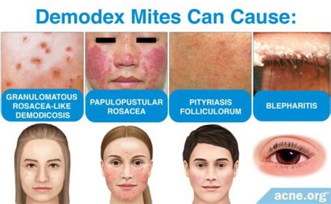 What Are Demodex Mites And What Role Do They Play In Acne Acne Org