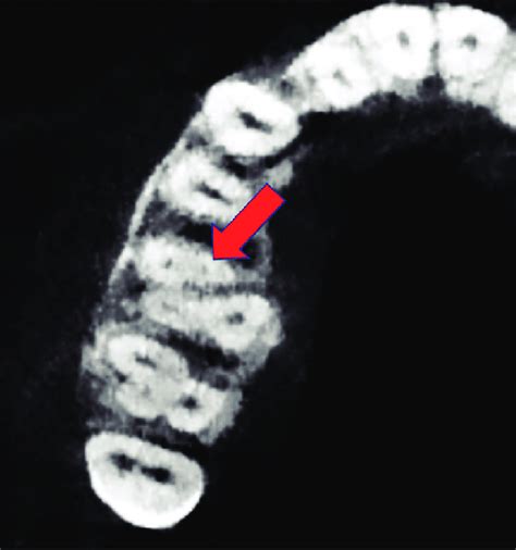 Mb2 Root Canal Location In A Right Maxillary First Molar Using Cbct Download Scientific Diagram