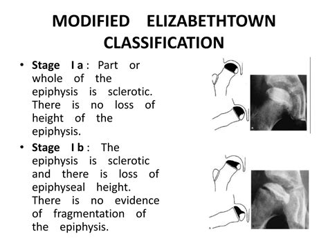 Perthes Disease Pptx