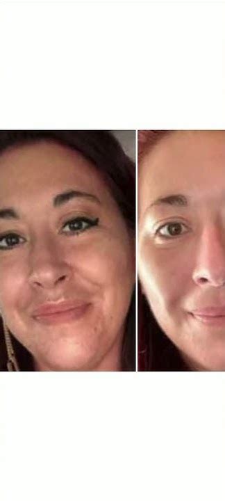 Chin Acne Hyperpigmentation Redness All Gone With My Safe Science
