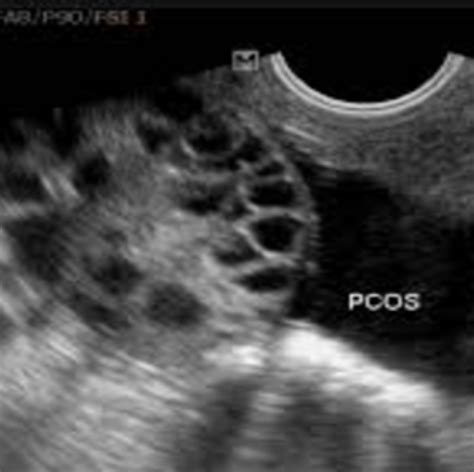 Pcos Xai Ultrasound Real World Training Dataset Kaggle
