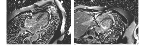 A Four Chamber Phase Sensitive Inversion Recovery Sequences Inversion Download Scientific