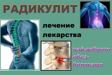 Радикулит: как се лекува? Всички лекарства. Профилактика и упражнения ...