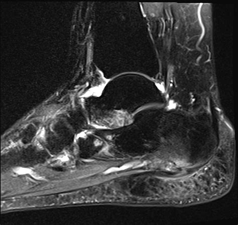 Plantar Fasciitis Mri